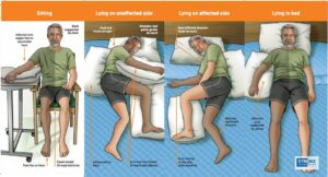 Physiotherapy in Stroke Rehabilitation ‘Acute/Assessment Phase’