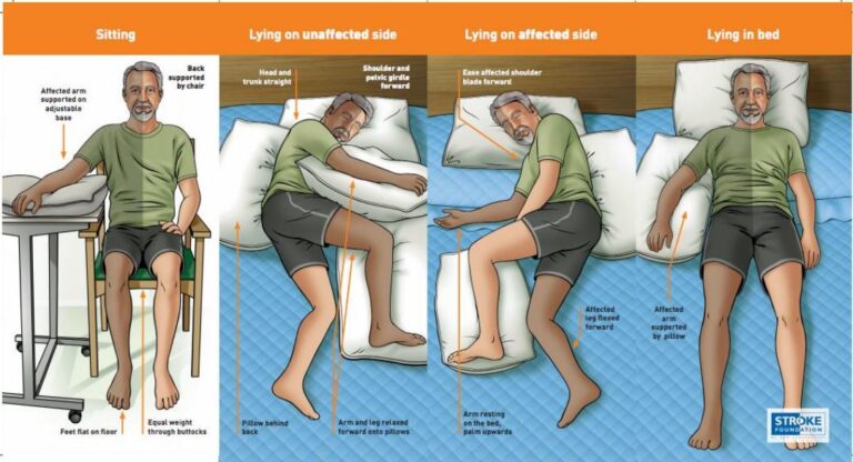 Physiotherapy in Stroke Rehabilitation ‘Acute/Assessment Phase’